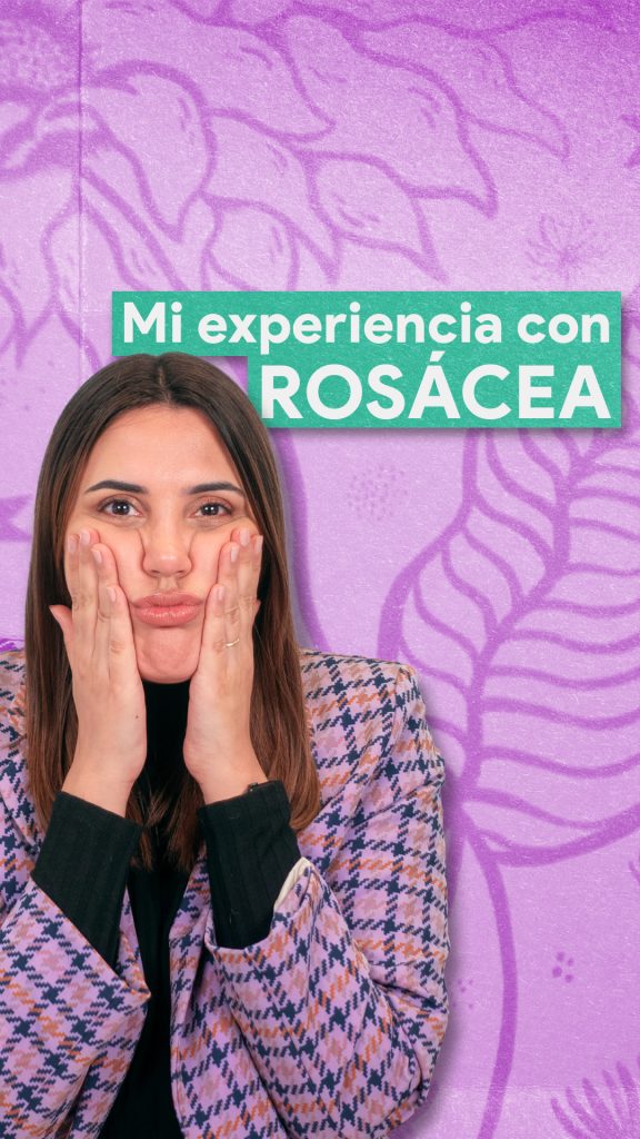 Mi experiencia con ROSÁCEA - Todo lo que tenes que saber - Dadatina